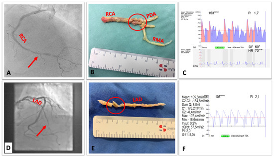 Role of Antiplatelet Therapy in Patients with Severe Coronary Artery ...