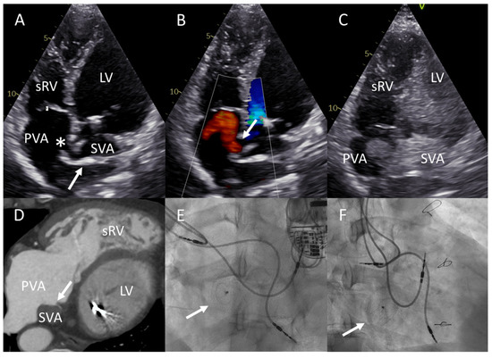 Contemporary Management Strategies of Baffle Leaks in Adults with a ...