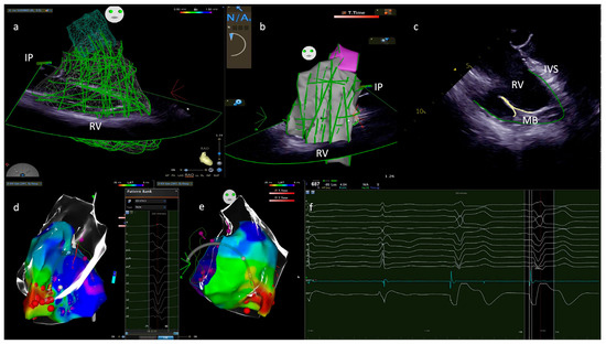 Moderator Band and Ventricular Tachycardia: Structural or Functional ...
