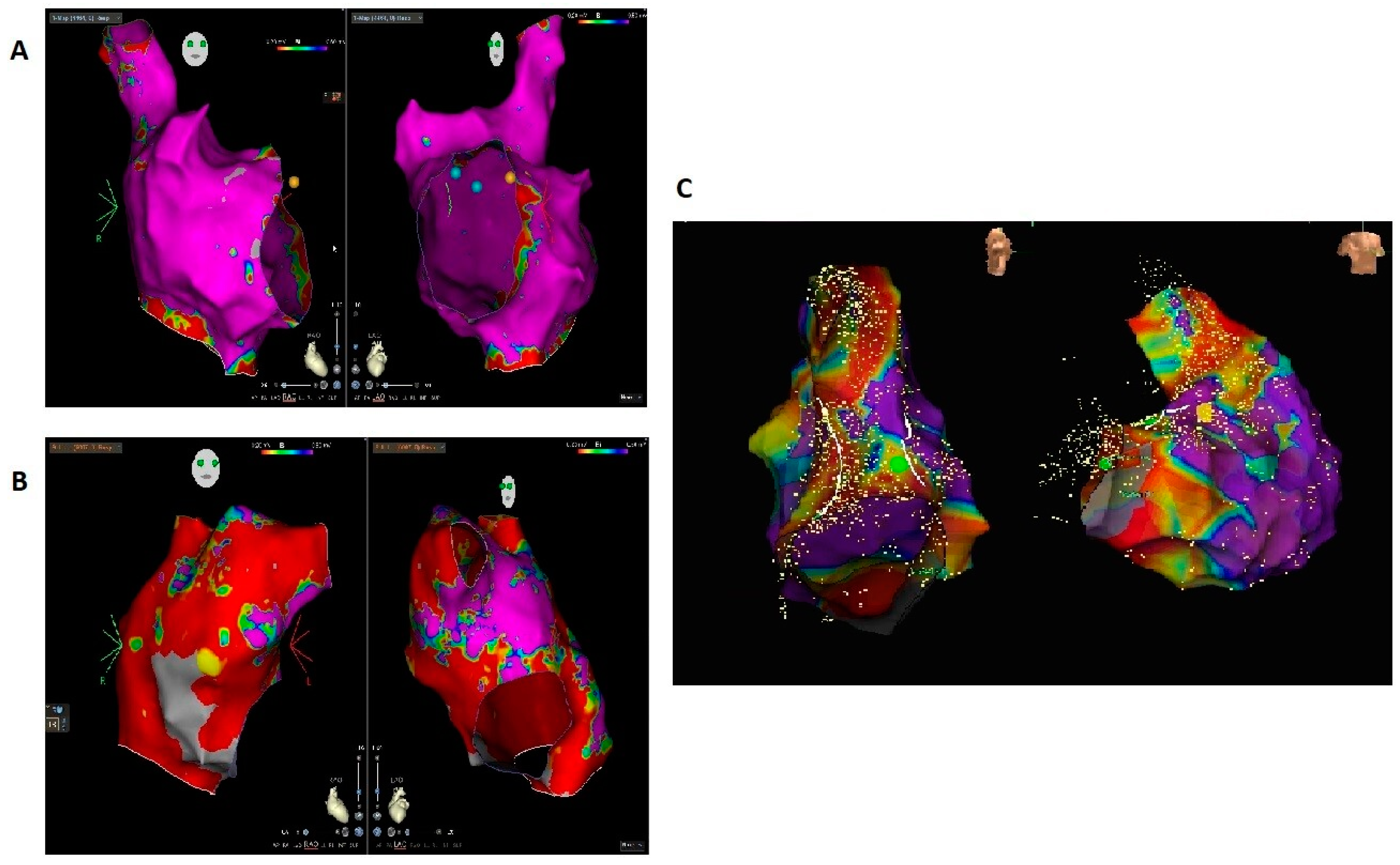Clinical Impact of Cardiac Fibrosis on Arrhythmia Recurrence after Ablation in Adults with ...