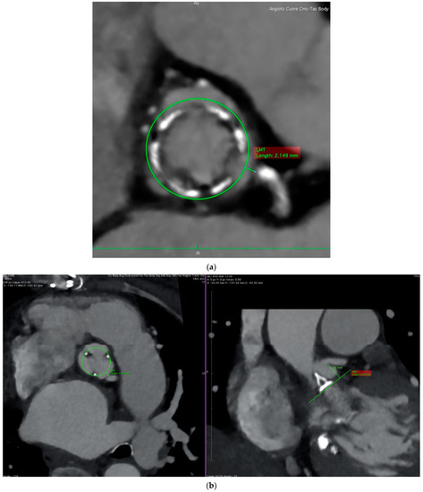 Coronary Obstruction during Valve-in-Valve Transcatheter Aortic Valve ...