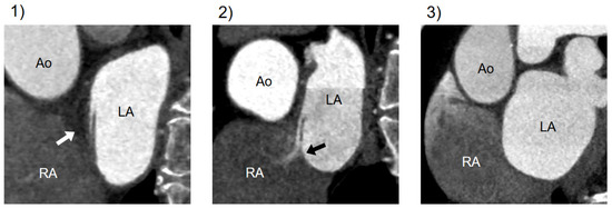 Diagnostic Performance of Cardiac Computed Tomography for Detecting ...