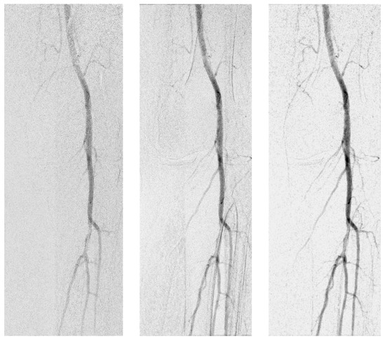 Radiation Exposure Reduction by Digital Variance Angiography in Lower ...