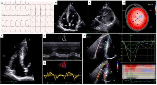 Solving the Riddle of Sudden Cardiac Death in Hypertrophic ...