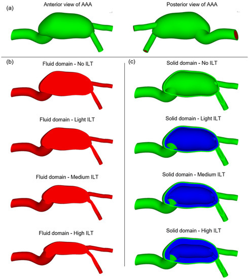 Effect of Intraluminal Thrombus Burden on the Risk of Abdominal Aortic ...