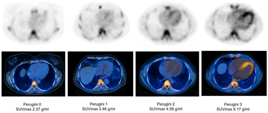 Quantitative SPECT/CT Parameters in the Assessment of Transthyretin ...