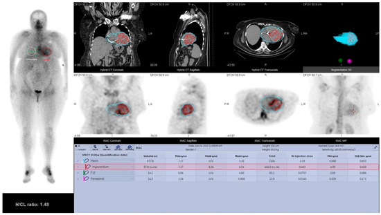 Quantitative SPECT/CT Parameters in the Assessment of Transthyretin ...