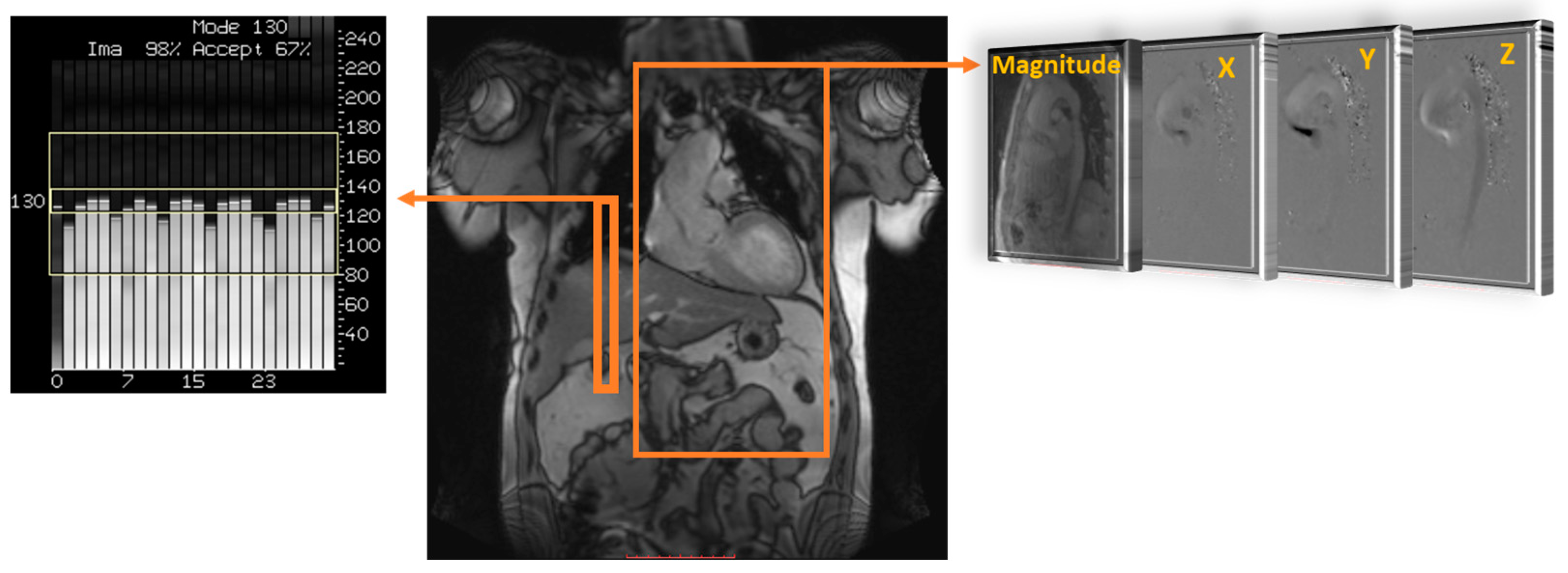 Clinical Use of Blood Flow Analysis through 4D-Flow Imaging in Aortic Valve Disease
