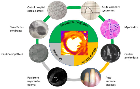 Cardiac Magnetic Resonance—Detected Acute Myocardial Edema as Predictor ...