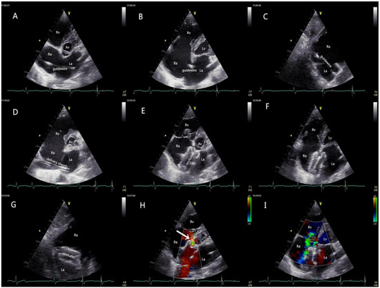 Complete Transthoracic Echocardiography for the Assessment and Guidance ...