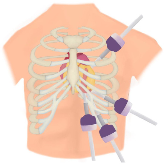 Minimal-Access Coronary Revascularization: Past, Present, and Future