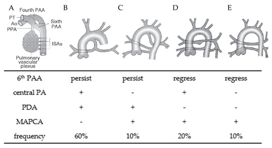 Unique Pulmonary Hypertensive Vascular Diseases Associated with Heart ...