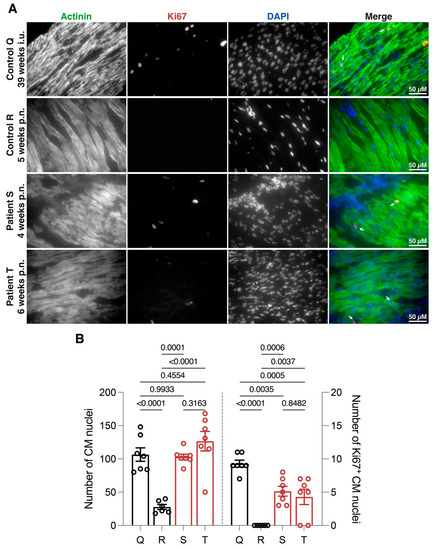 Maturation and Function of the Intercalated Disc: Report of Two ...