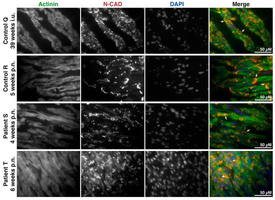 Maturation and Function of the Intercalated Disc: Report of Two ...