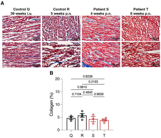 Maturation and Function of the Intercalated Disc: Report of Two ...