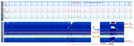 Recognition of Supraventricular Arrhythmias in Holter ECG Recordings by ...