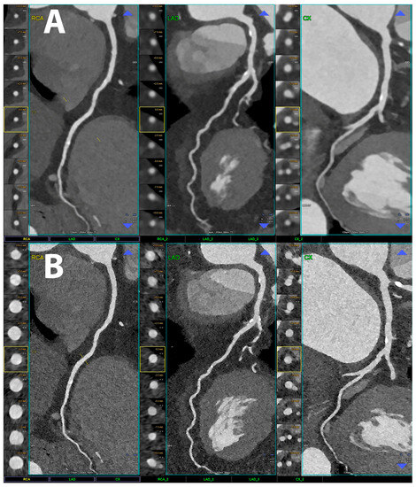 JCDD | Free Full-Text | Cardiovascular Applications of Photon-Counting ...