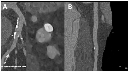 Cardiovascular Applications of Photon-Counting CT Technology: A ...