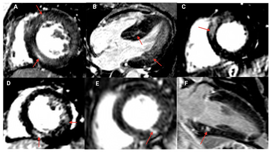 Cardiac Morphology, Function, and Left Ventricular Geometric Pattern in ...