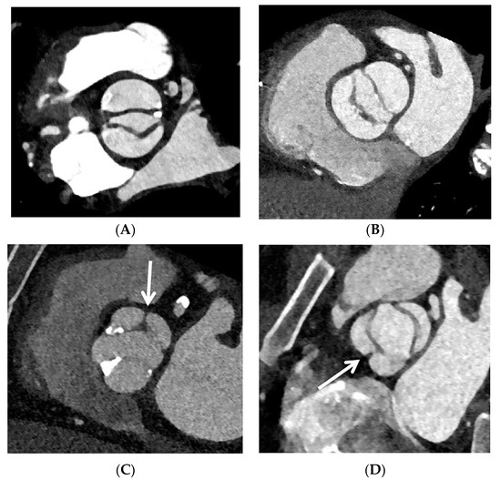 Aortic Valve Dysfunction and Aortopathy Based on the Presence of Raphe ...