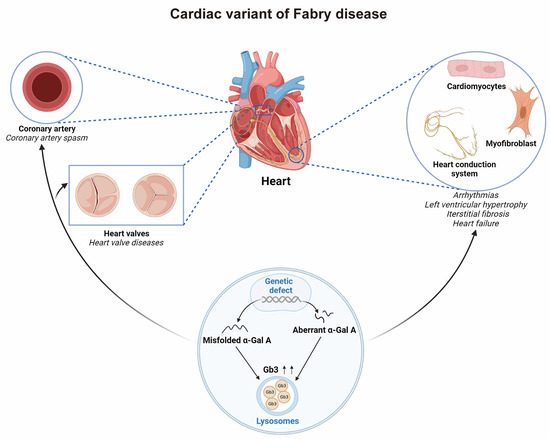 Unexplained Left Ventricular Hypertrophy Diagnosed as a Cardiac Variant ...