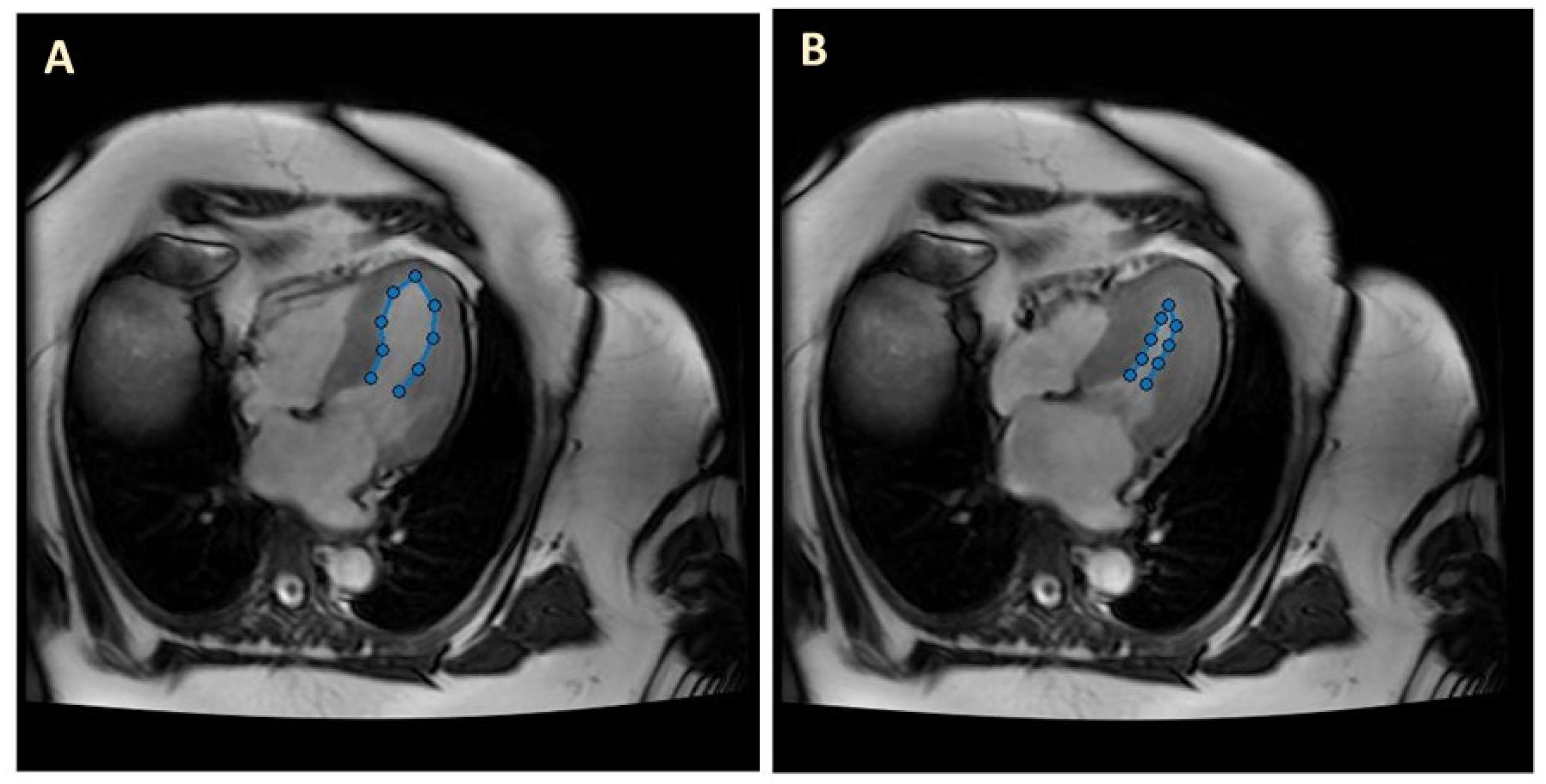Energetics of Cardiac Blood Flow in Hypertrophic Cardiomyopathy through ...