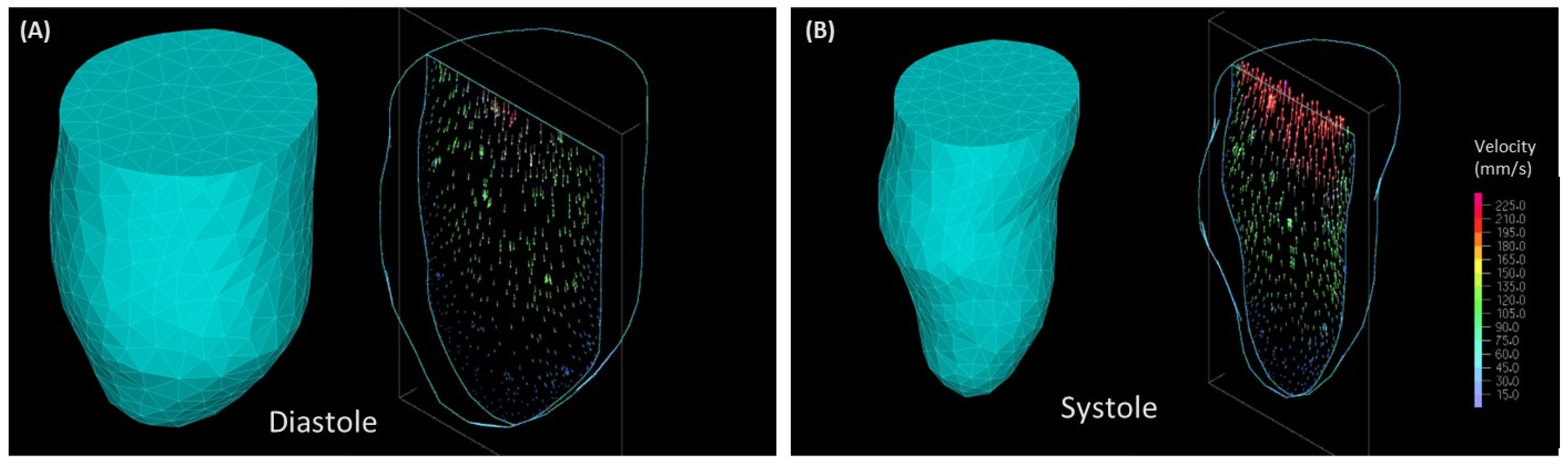 Energetics of Cardiac Blood Flow in Hypertrophic Cardiomyopathy through ...