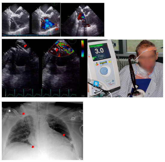 Hedinger Syndrome—Lessons Learnt: A Single-Center Experience