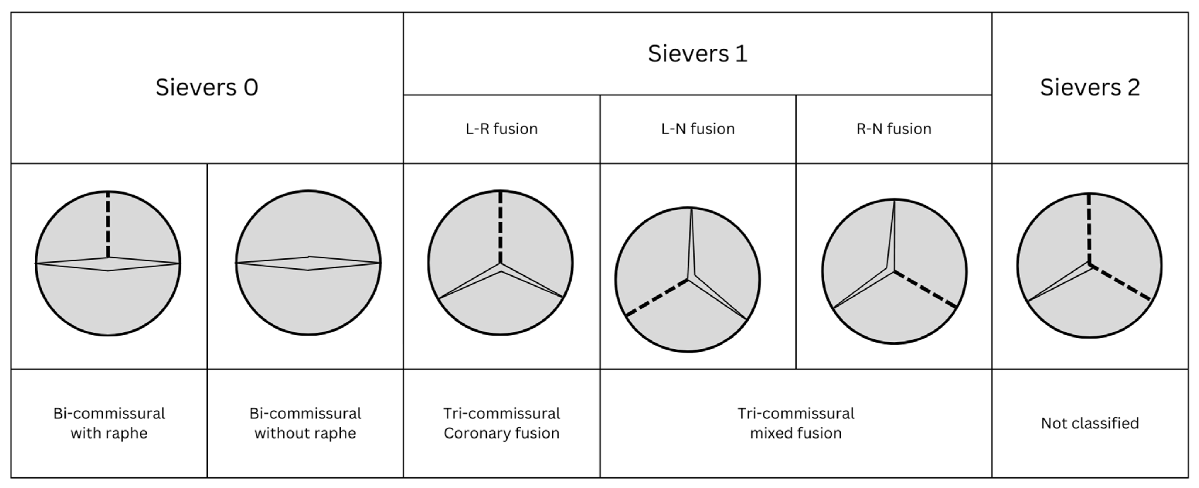 Transcatheter Aortic Valve Therapy for Bicuspid Aortic Valve Stenosis