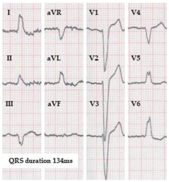 Useful Electrocardiographic Signs to Support the Prediction of ...