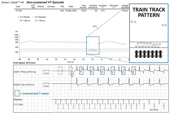 T-Wave Oversensing with Contemporary Implantable Cardioverter ...