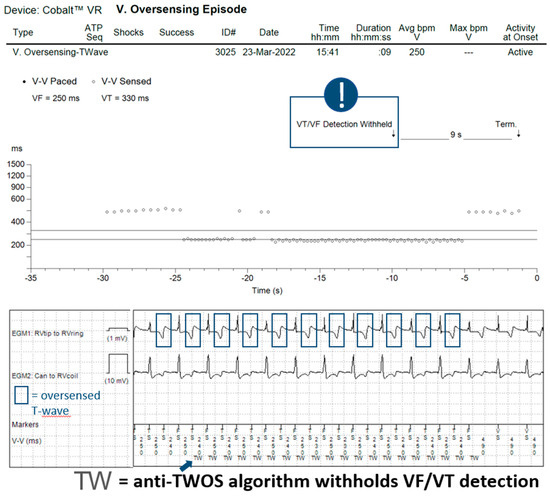 T-Wave Oversensing with Contemporary Implantable Cardioverter ...