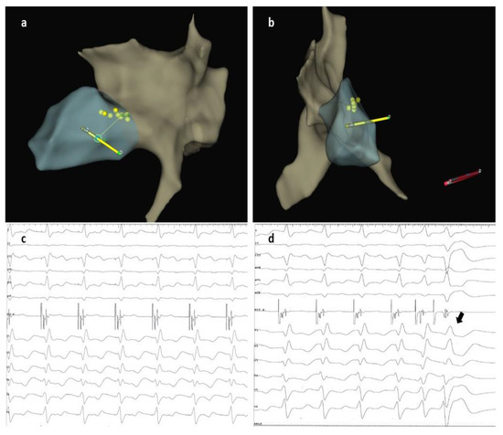 Optimal Cardiac Resynchronization Therapy with Conduction System Pacing ...