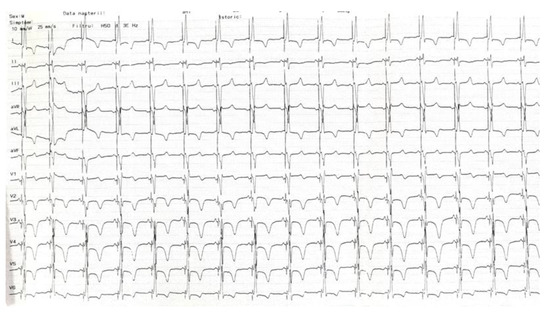 Optimal Cardiac Resynchronization Therapy with Conduction System Pacing ...