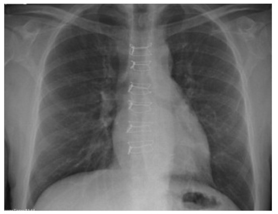 Surgical Strategy for Sternal Closure in Patients with Surgical ...