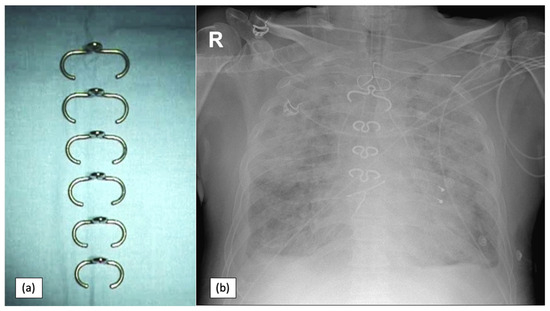 Surgical Strategy for Sternal Closure in Patients with Surgical ...