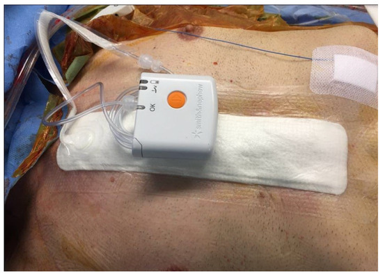 Surgical Strategy for Sternal Closure in Patients with Surgical ...