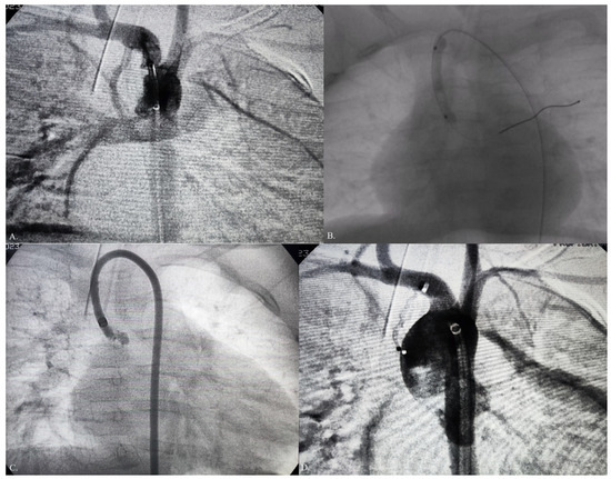 JCDD | Free Full-Text | Percutaneous Modified Blalock–Taussig Shunt ...