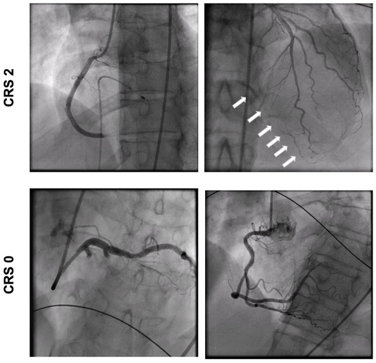 Association of Coronary Collaterals and Myocardial Salvage Measured by ...