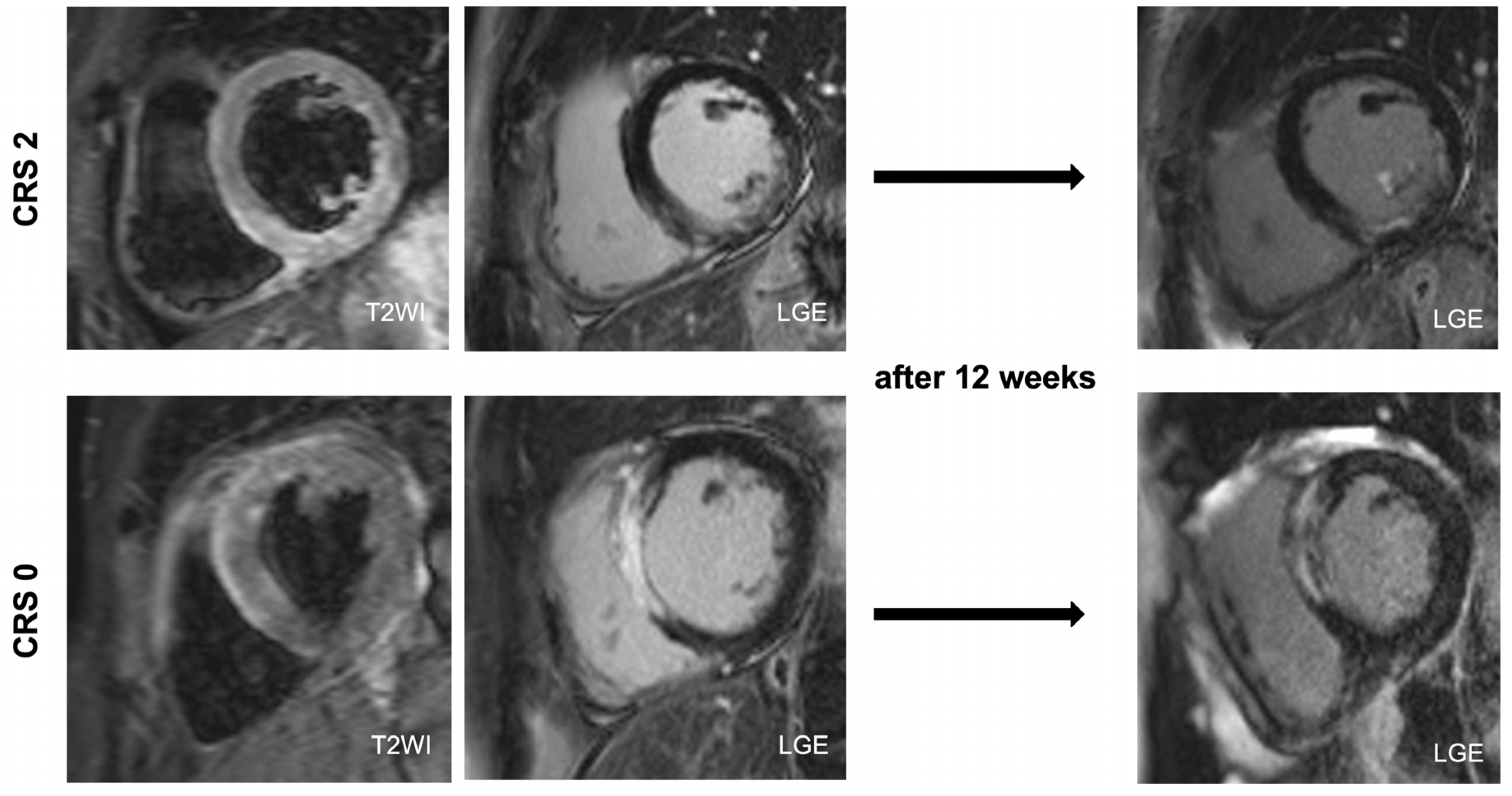 Association of Coronary Collaterals and Myocardial Salvage Measured by ...