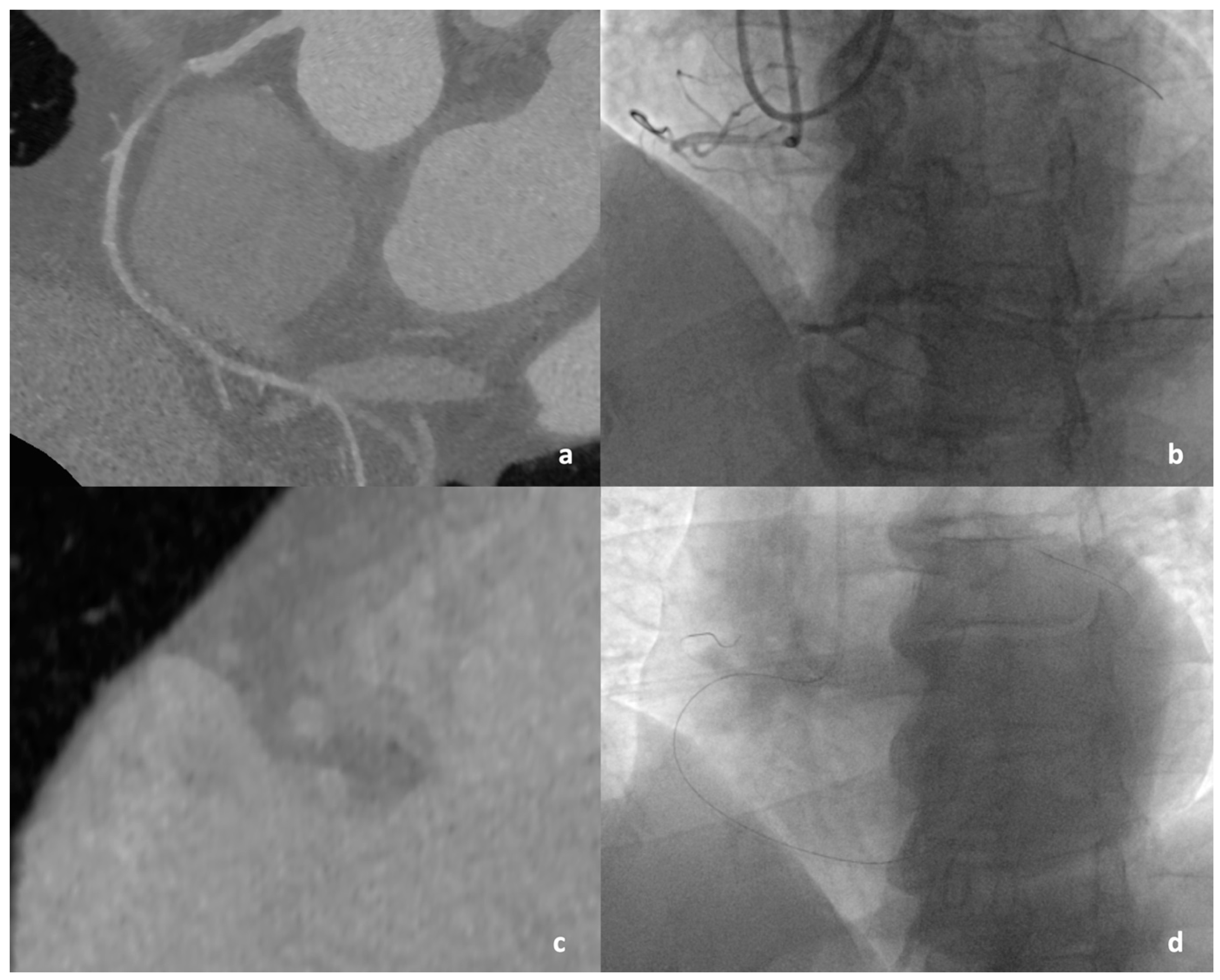Computed Tomography Angiography-Derived Scores for Prediction of Chronic Total Occlusion ...