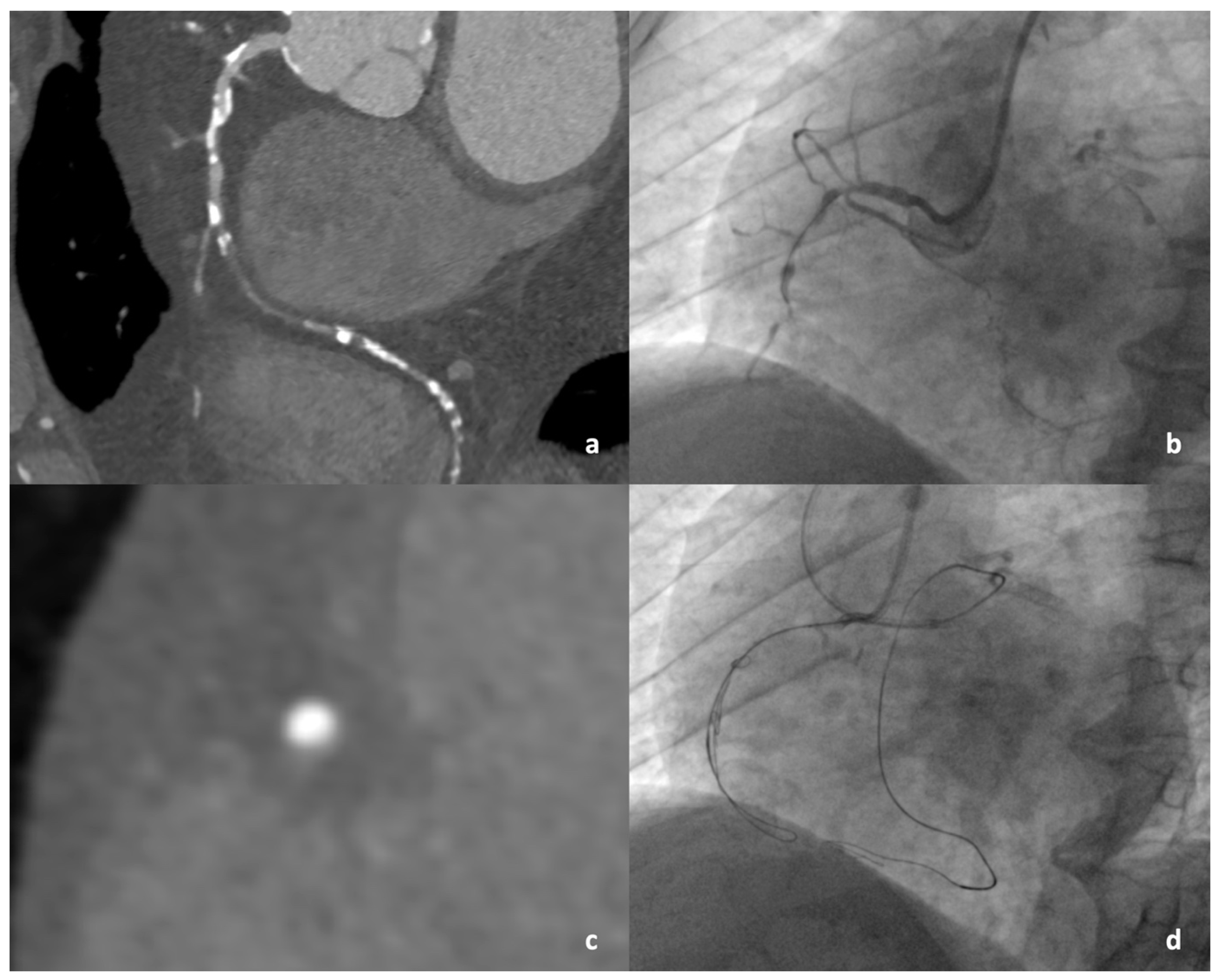 Computed Tomography Angiography-Derived Scores for Prediction of Chronic Total Occlusion ...