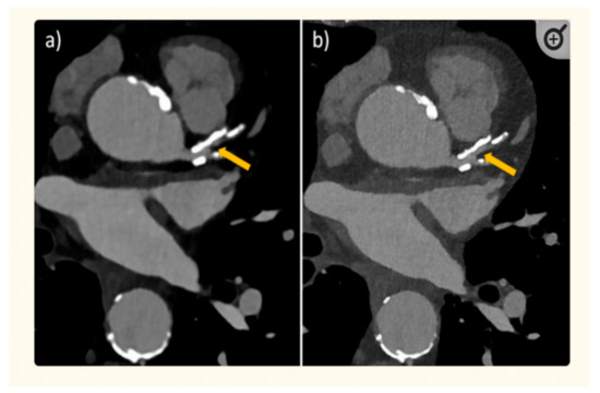 Cardiovascular Computed Tomography in the Diagnosis of Cardiovascular ...