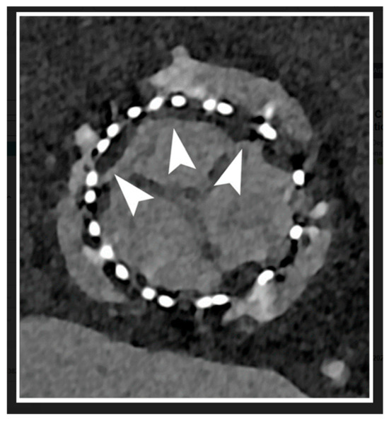 Cardiovascular Computed Tomography in the Diagnosis of Cardiovascular ...