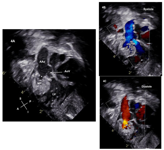 Ruptured Sinus of Valsalva Aneurysm with Resultant Myocardial Pouch ...