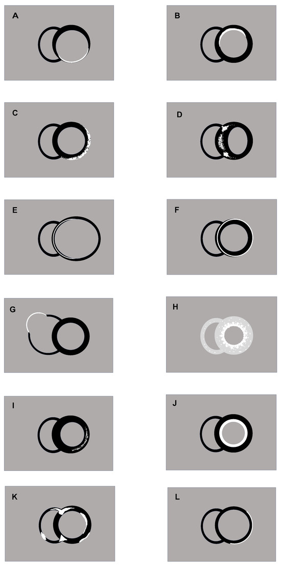Myocardial Late Gadolinium Enhancement (LGE) in Cardiac Magnetic ...