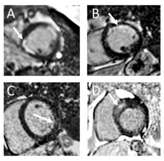 Myocardial Late Gadolinium Enhancement (LGE) in Cardiac Magnetic ...
