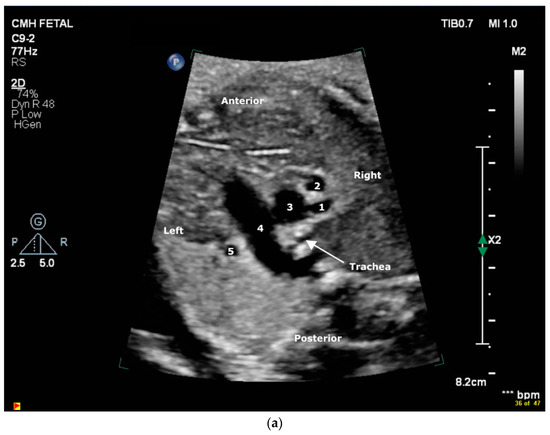 Prenatal Diagnosis of a Ductal-Dependent Branch Pulmonary Artery: Extra ...