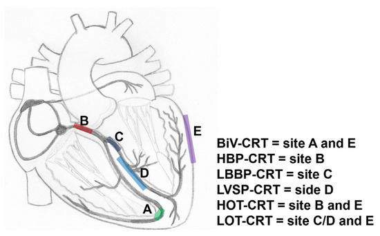 Ultra-High-Frequency ECG in Cardiac Pacing and Cardiac ...