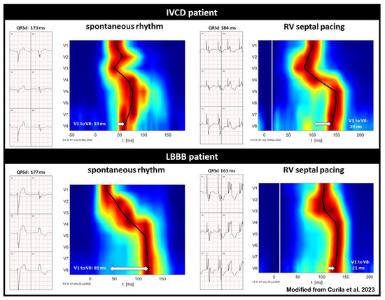 Ultra-High-Frequency ECG in Cardiac Pacing and Cardiac ...